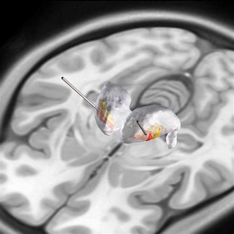 Types Of Encephalitis A Mayo Clinic Expert Explains Mayo Clinic News