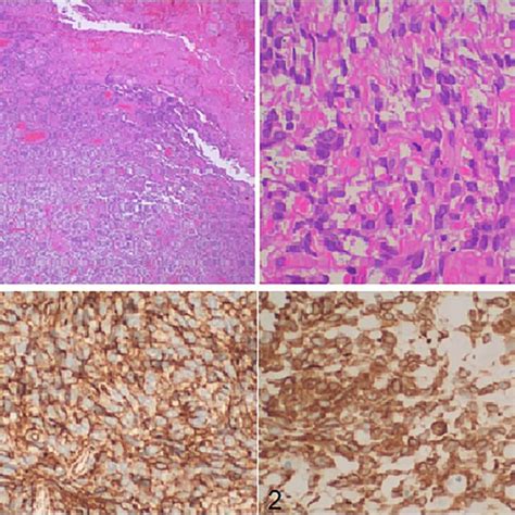 A Solitary Fibrous Tumour Our Patients Tumour Histological