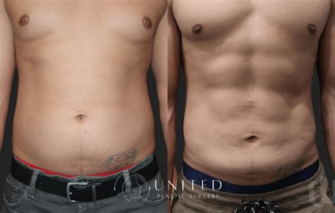 Liposuction United Plastic Surgery