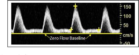 Figure 1 From Interpretation Of Peripheral Arterial And Venous Doppler