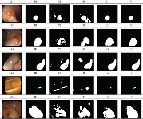 Segmentation In Colorectal Endoscopy Images Ai Original Images Bi Download Scientific
