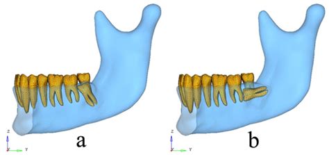 A Fem Model 1 Mesioangular Impaction B Fem Model 2 Horizontal