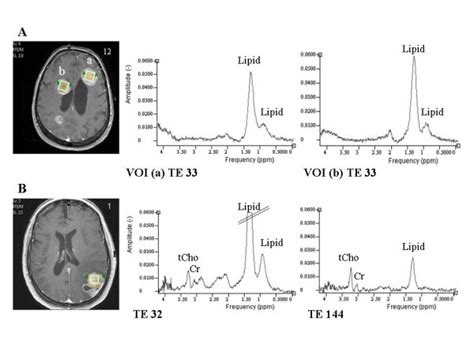 Brain Metastases In Vivo Spectra Axial T1 Weighted Contrast Enhanced Download Scientific