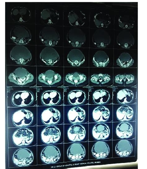 Ct Scan View Of Large Ovarian Mass Download Scientific Diagram
