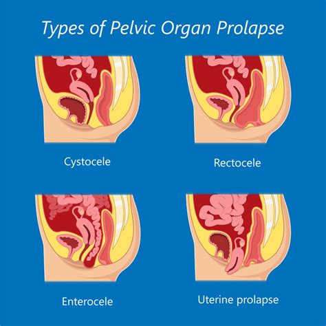 A Complete Guide To Pelvic Organ Prolapse