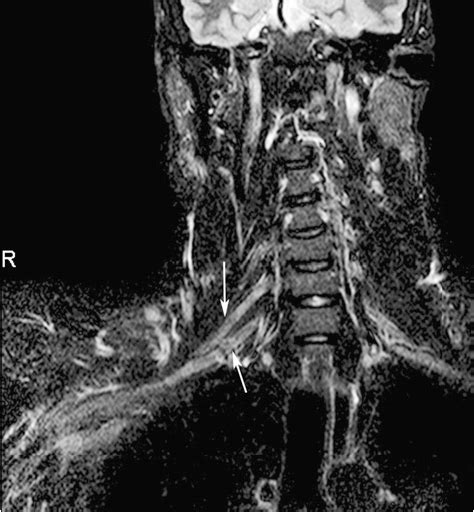 Brachial Plexus Mri