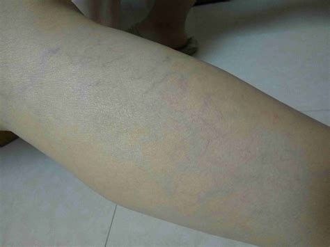 大腿毛细血管明显腿上毛细血管明显 伤感说说吧