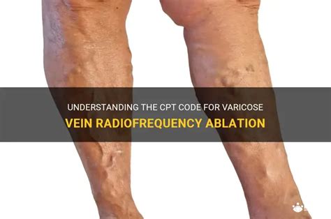 Understanding The Cpt Code For Varicose Vein Radiofrequency Ablation