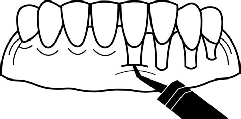 Chao Pinhole Surgical Technique™️ — Michigan Implants And Periodontics