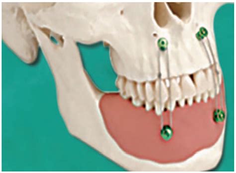 Fixation In Maxillofacial Surgery—past Present And Future A Narrative