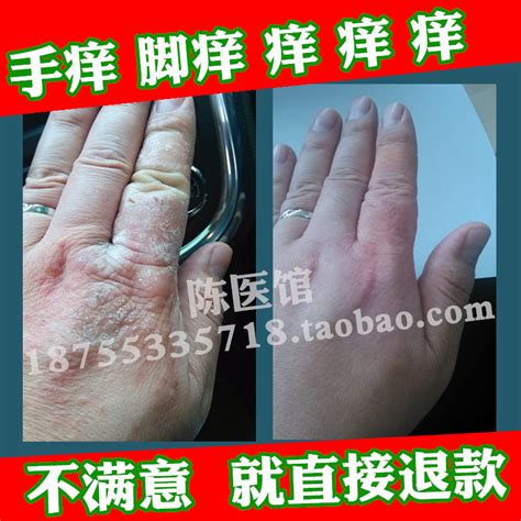 手痒 特效 症状 大山谷图库