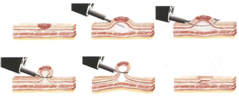Geelong Gastro Endoscopic Mucosal Resection Emr