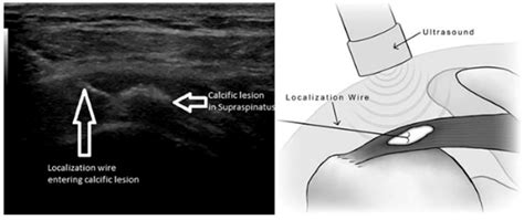 Ultrasound Guided Barbotage Procedure For Calcific