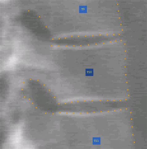 Automated Vertebral Fracture Assessment