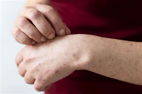Skin Lesions Treatments Windsor B At The Top