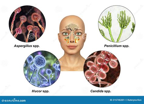 Fungi As A Cause Of Sinusitis 3d Illustration Showing Inflammation Of