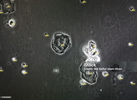 Gambar Mikroskopis Urinalisis Abnormal Pemeriksaan Urin Foto Stok