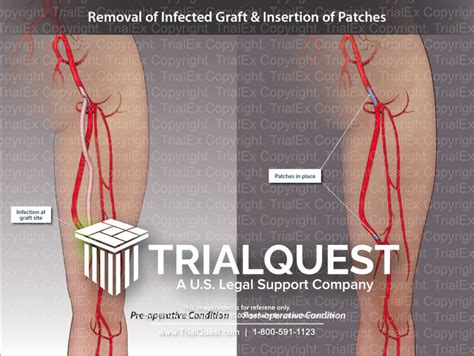 Tutoplast Patch Graft