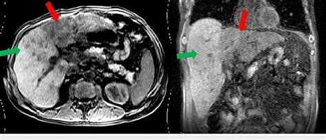 Magnetic Resonance Imaging Of The Liver In Axial Left And Coronal