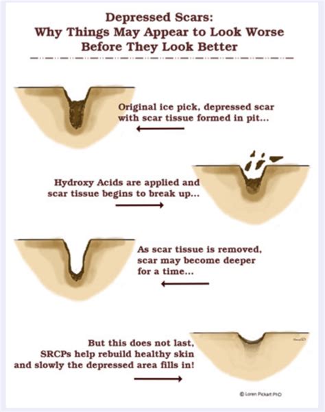Fade Acne Scars Fast 4 Products At Home Process