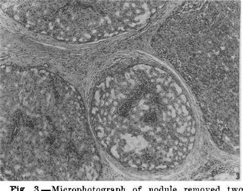 Figure 3 From Hypodermal Myiasis Caused By Larvae Of The Ox Warble
