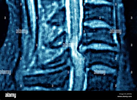 Herniated Disc Mri Hi Res Stock Photography And Images Alamy