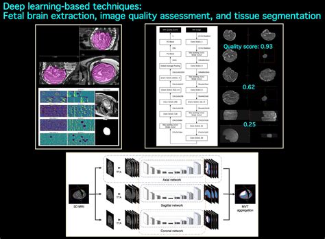 Fetal Brain Mri Pipeline Neuroim Lab