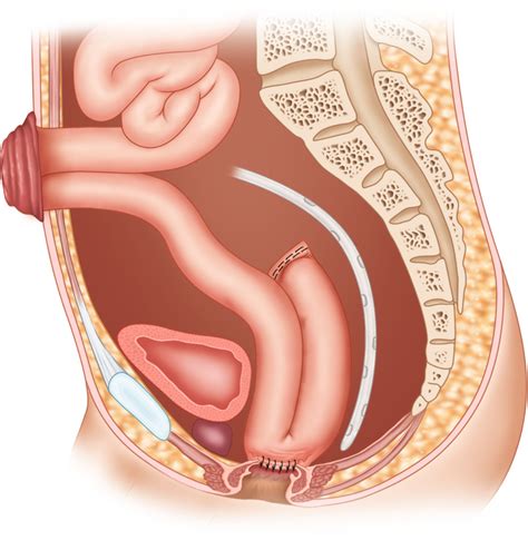 Complications Of The Ileal Pouch Springerlink