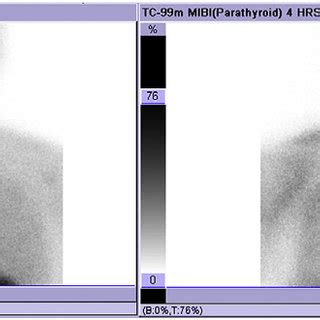 99mTc Sestamibi Scan Negative For Parathyroid Adenoma But A Focal