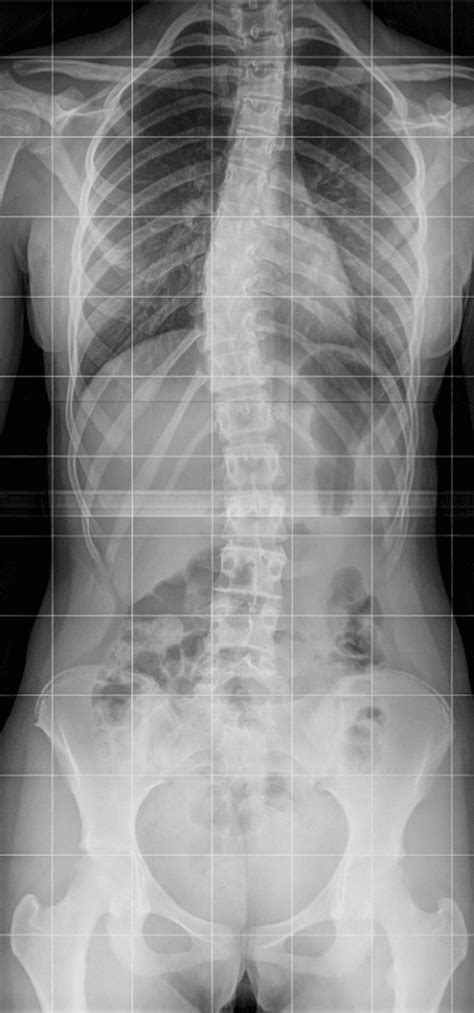 Scoliosis