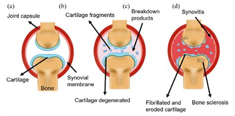 Schematic Diagram Of Oa Progression A Normal Healthy Joint B