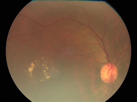 What Is Non Proliferative Diabetic Retinopathy Advanced Retina Care