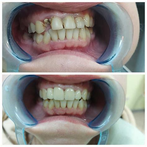 Хирург Стоматолог в Барнауле Удаление Зубов без Боли с Доктором Смайл