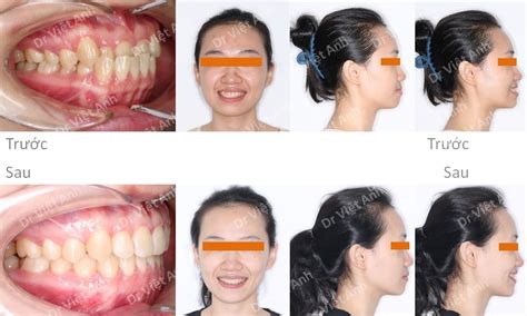 Ca Niềng Răng Mắc Cài Kim Loại Tự động Khắc Phục Móm Khớp Cắn Ngược