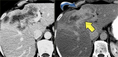 The Radiology Assistant Biliary Ducts Pathology