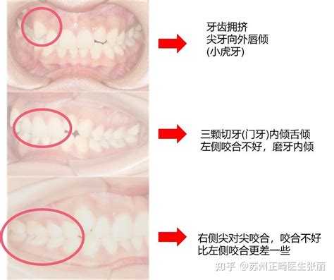 参照物错觉有时候嘴凸不一定是凸还可能是下巴后缩成年人金属自锁矫治虎牙拥挤后缩 知乎