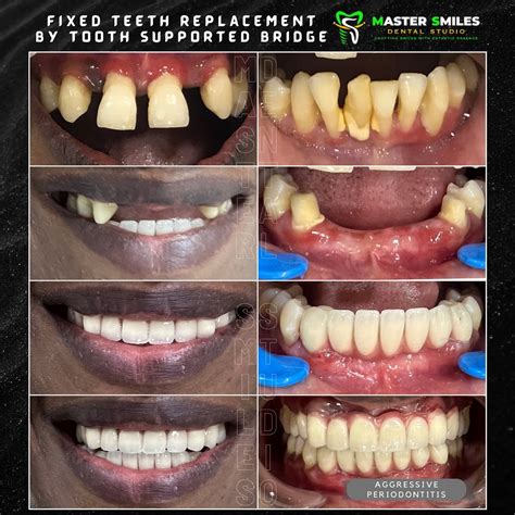 Master ⚠️fixed Partial Denture Tooth Supported Bride A Tooth