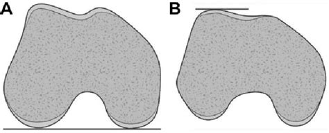 Illustrations Of How To Measure The Lateral Trochlear Inclination Lti Download Scientific