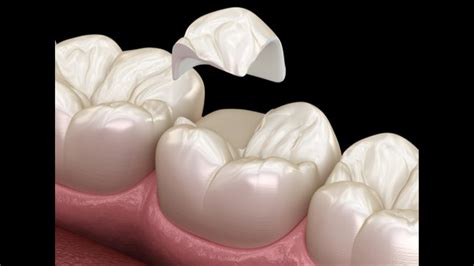 What Are Dental Inlays And Onlays Dr Jamilian