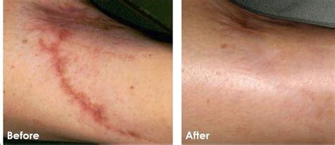 2N Super Anti Scars Essence Remove Scar Cream Remove Acne Spots Remove Striae Gravidarum