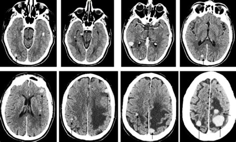Computerized Tomography Scan Performed At Initial Diagnosis A Tumor