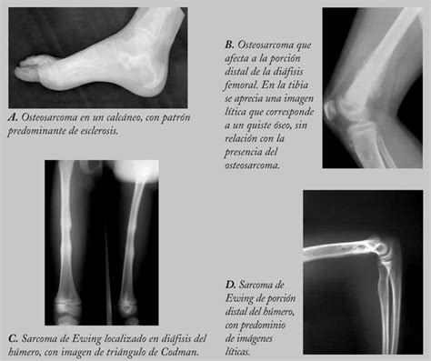 Ewing Sarcoma The Most Recent Advances In The Knowledge Of This Disease