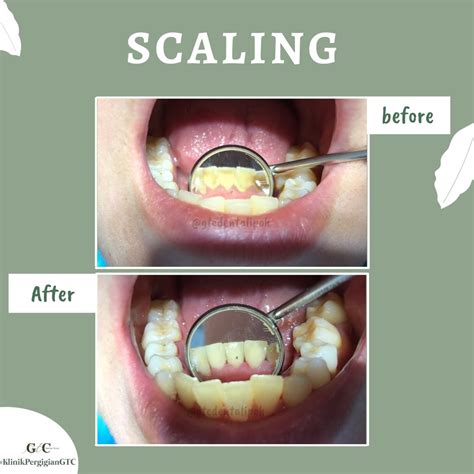 Scaling Gtc Dental Ipoh Garden
