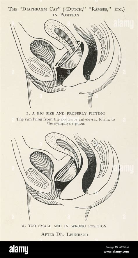 Contraception Diaphragm Stock Photo Alamy