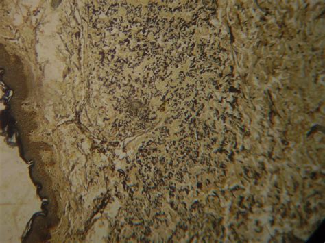 My Pathology Pseudoxanthoma Elasticum