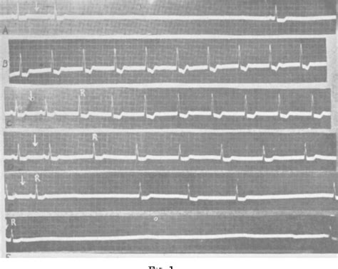 Figure 1 From Comparative Actions Of Dextro And Levo Epinephrine On Human Heart Semantic Scholar
