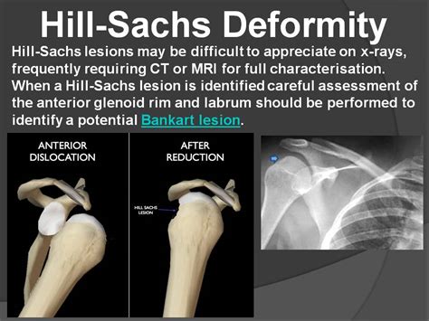 Hill Sachs Deformity Radiology Classroom Facebook