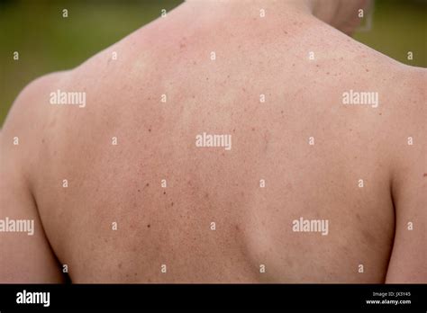 Women With Skin Pigmentation On Back Skin Texture Background Stock