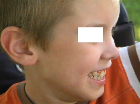 Dandy Walker Syndrome Pictures Causes Symptoms Treatment