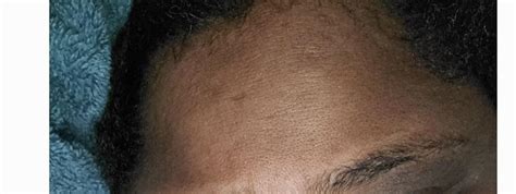 Forehead Texture Way Different Than Rest Of Face Rskincareaddicts